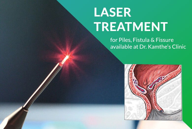 Laser Treatment in Pune | Dr. Kamthe's Piles Clinic